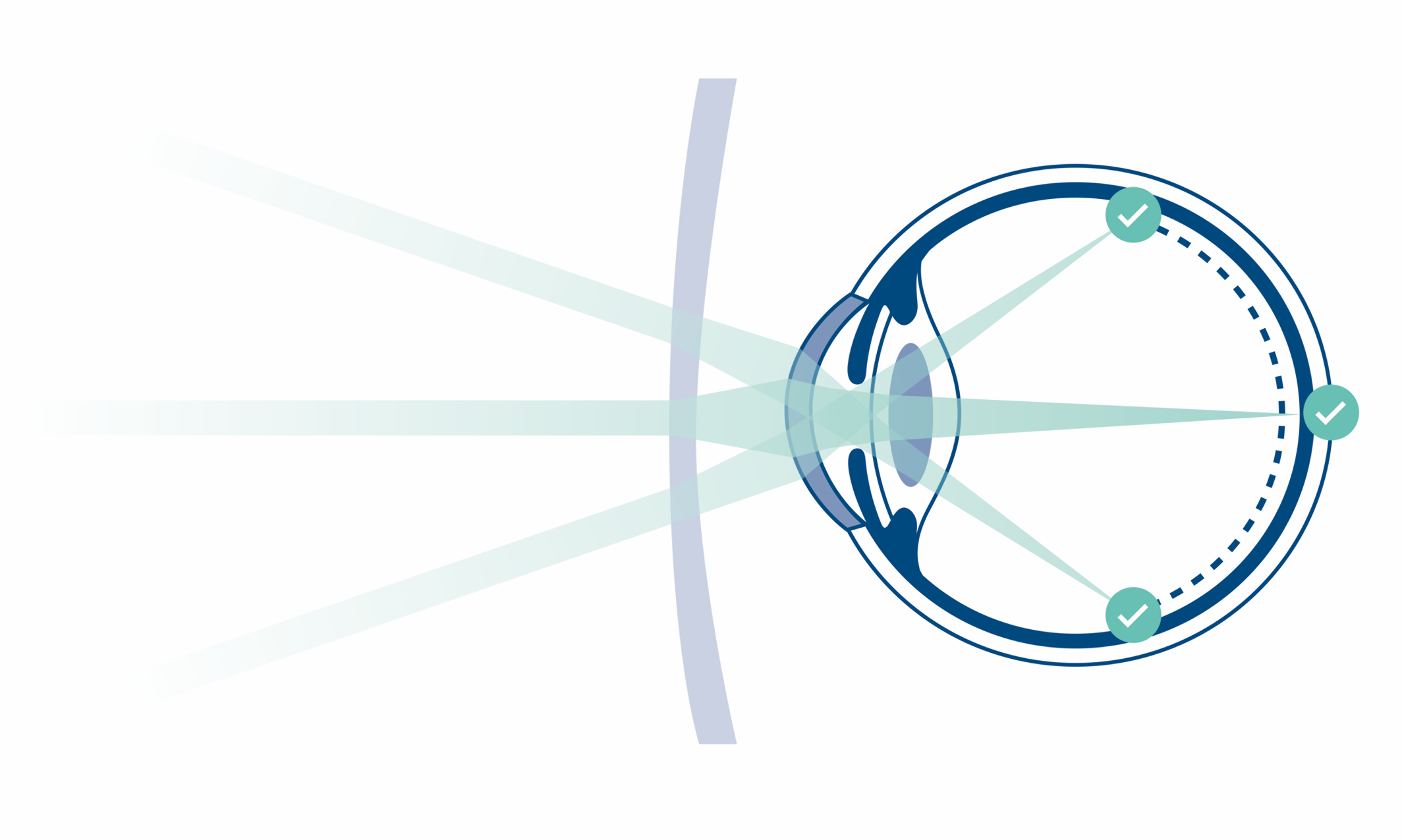 Myopikontroll - behandling av nærsynthet Pibo Optik